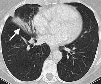 Ovid: Chest Radiology: The Essentials
